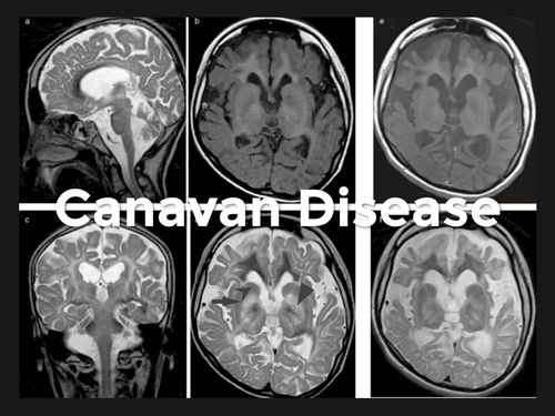 Book Creator | Canavan Disease